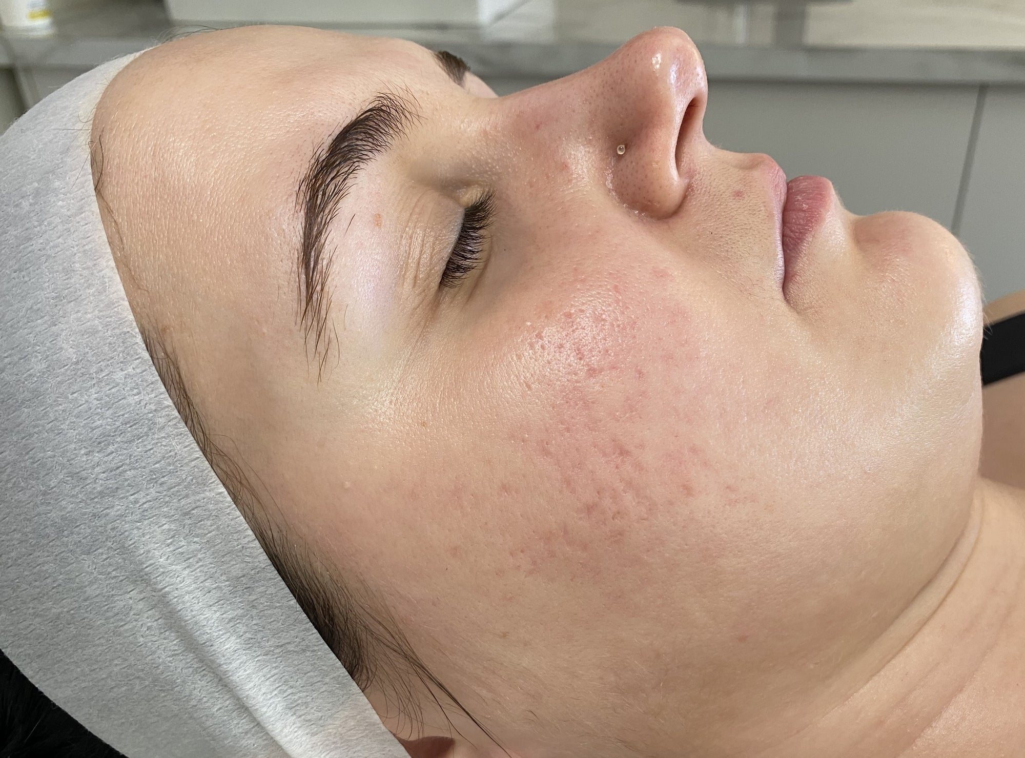 Mi:skn Clinic: Acne + Skin Experts in Perth – Mi Skn Clinic