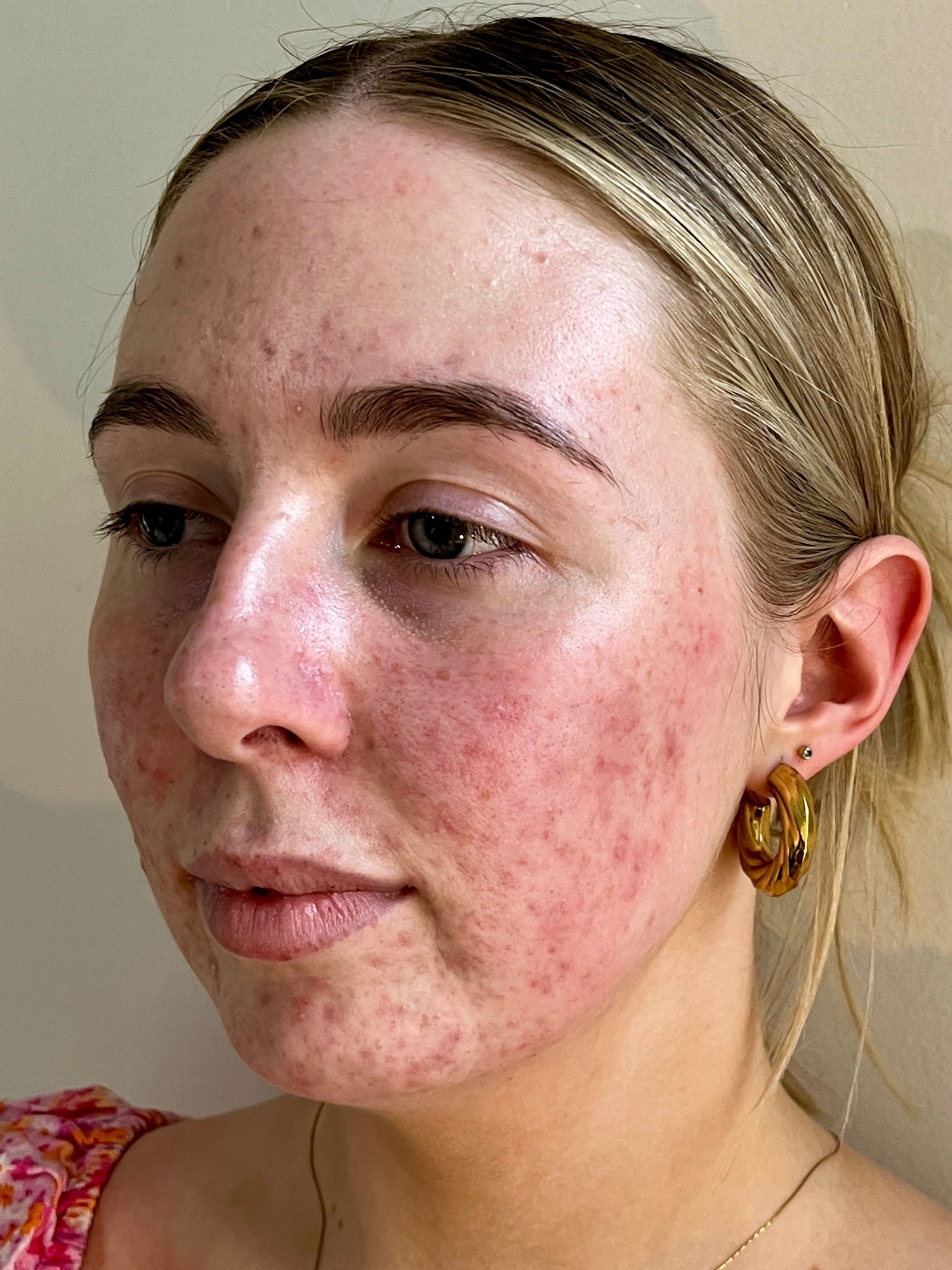 Acne Scars, Dark Spots and Hyperpigmentation – Mi:skn Clinic
