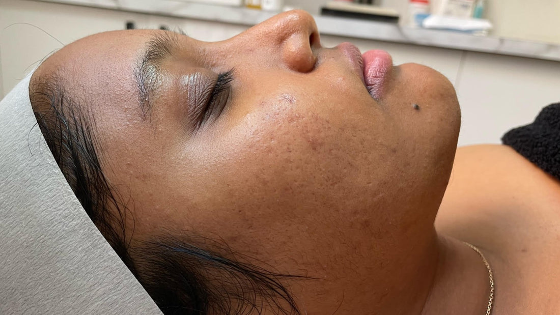 Acne Scars, Dark Spots and Hyperpigmentation | Mi Skn Clinic
